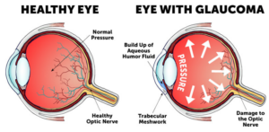 Glaucoma Fact Sheet – Vista Center for the Blind and Visually Impaired